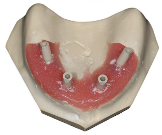 Accuracy of Implant Level Intraoral Scanning and Photogrammetry ...