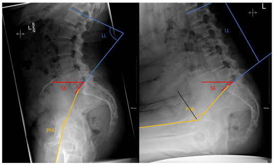 Spine, Pelvis and Hip Kinematics—Characterizing the Axial Plane in ...