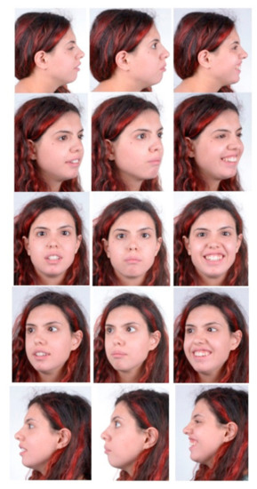 Full Digital Surgery-First, Skeletal Anchorage and Aligners Approach to ...