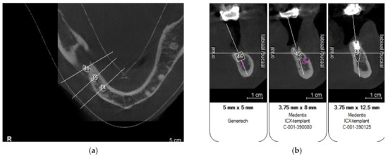 Allograft Customized Bone Blocks for Ridge Reconstruction: A Case ...