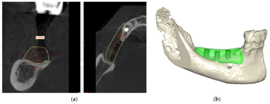 Allograft Customized Bone Blocks for Ridge Reconstruction: A Case ...