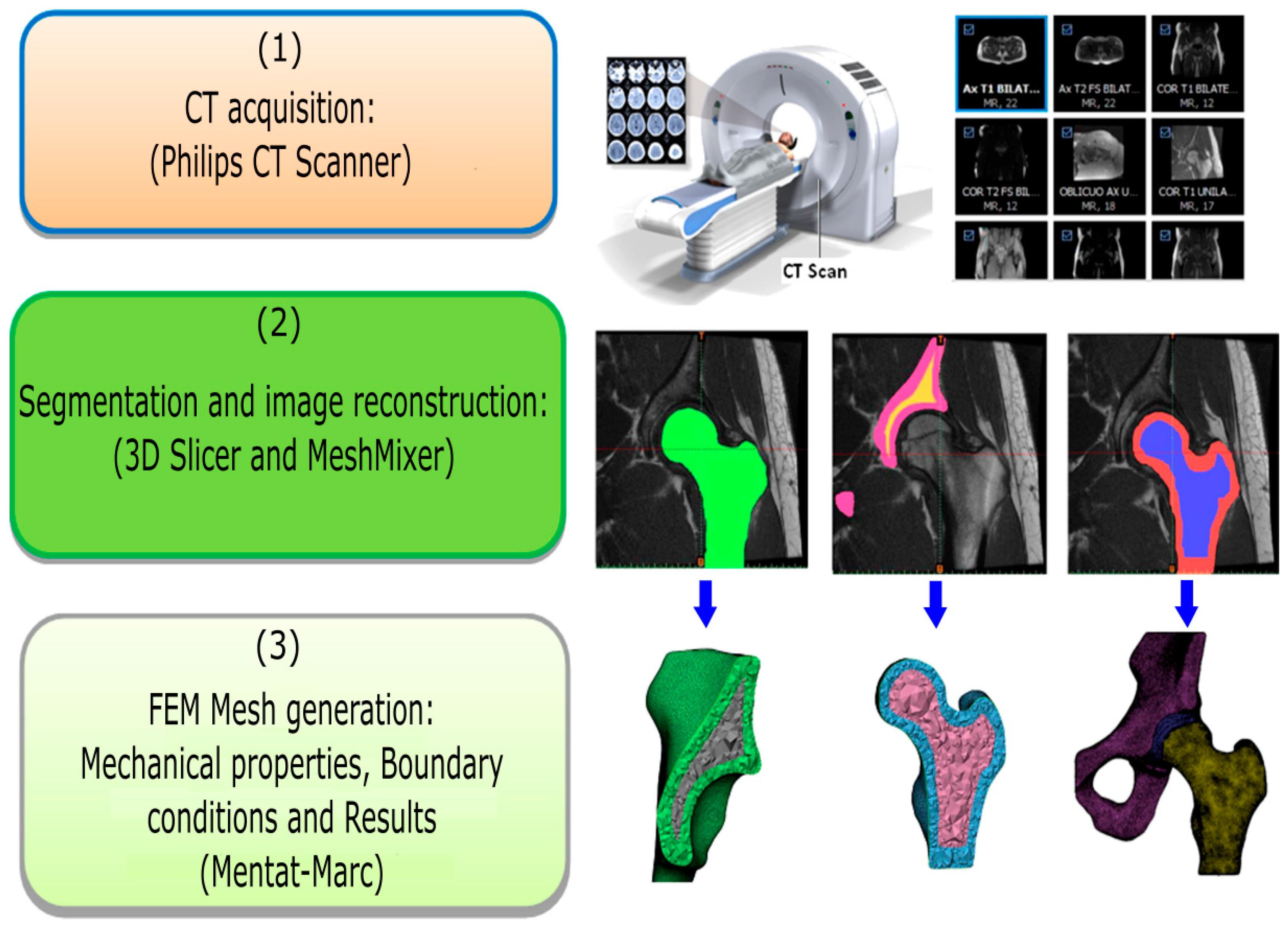 Comparative Analysis of Healthy and Cam-Type Femoroacetabular ...
