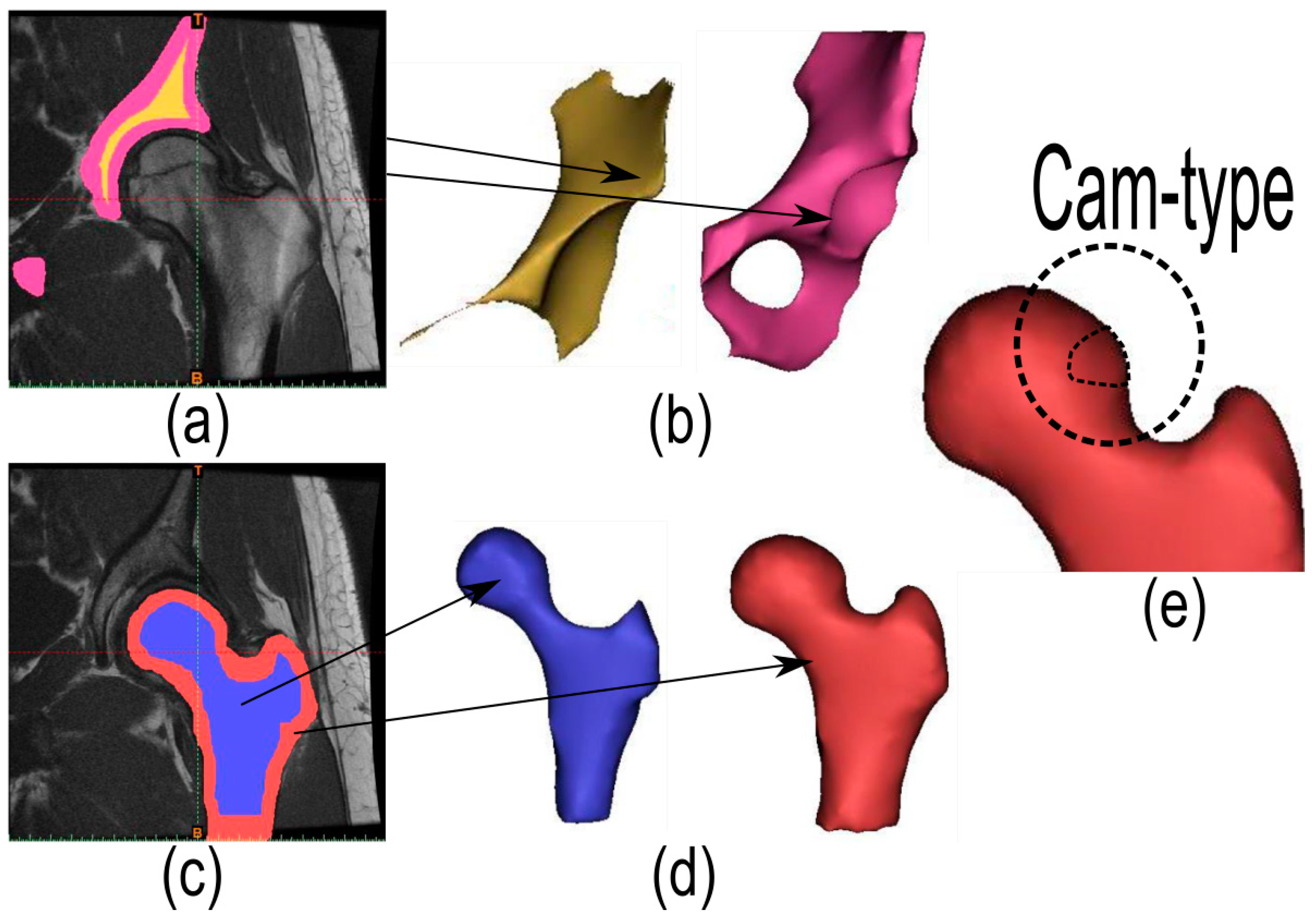 Comparative Analysis of Healthy and Cam-Type Femoroacetabular ...