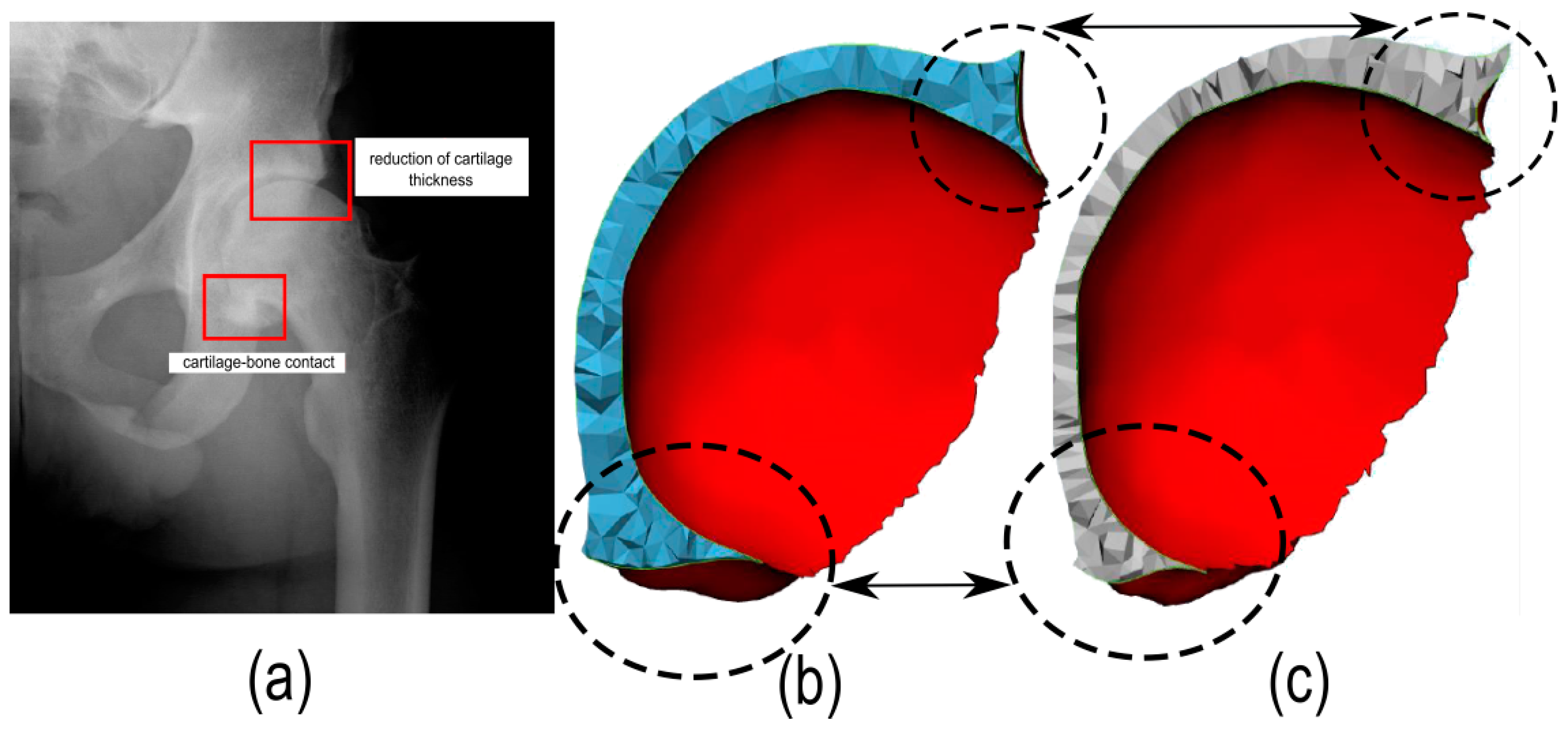 Comparative Analysis of Healthy and Cam-Type Femoroacetabular ...