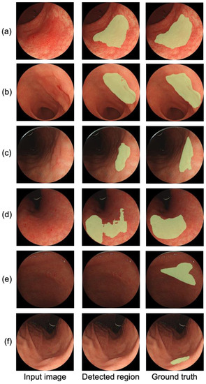 Automated Detection of Gastric Cancer by Retrospective Endoscopic Image ...