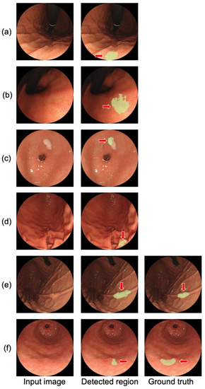 Automated Detection of Gastric Cancer by Retrospective Endoscopic Image ...