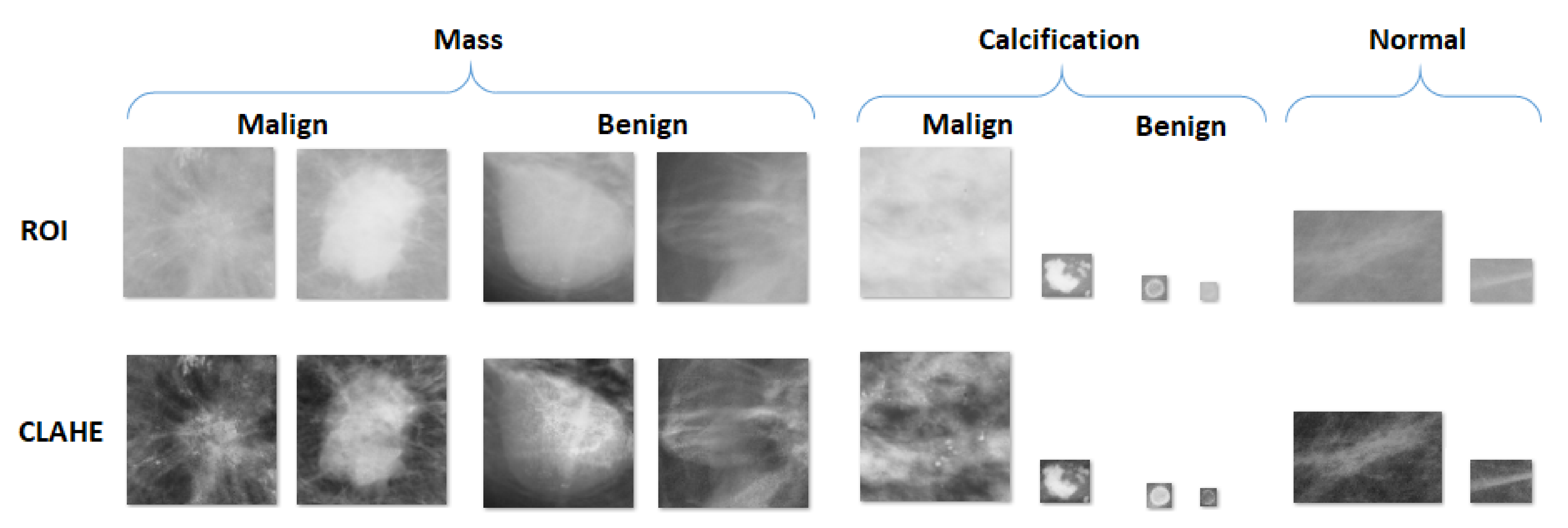 Classification of Breast Cancer in Mammograms with Deep Learning Adding a Fifth Class