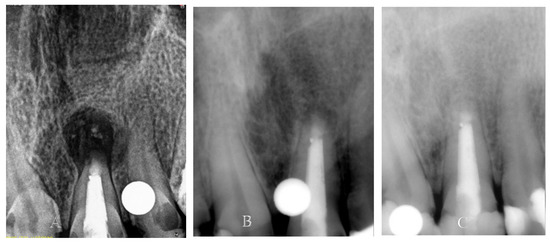 Factors Affecting the Outcome of Periapical Surgery; a Prospective ...