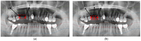Tooth Position Determination by Automatic Cutting and Marking of Dental ...