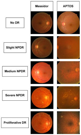 Diabetic Retinopathy Improved Detection Using Deep Learning
