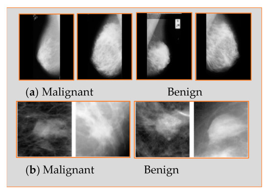 Breast Cancer Detection Using Mammogram Images with Improved Multi ...