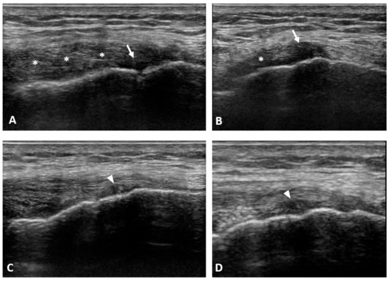 Treatment of Medial Collateral Ligament Injuries of the Knee with ...