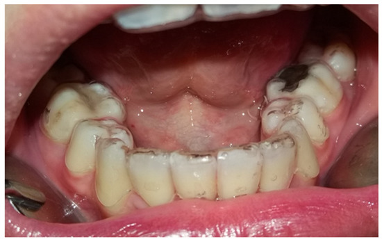 Retrospective Study Regarding Orthodontic Retention Complications in ...