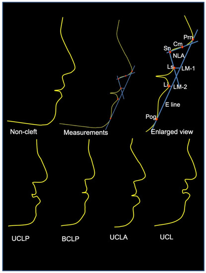 Evaluation of Lip Morphology and Nasolabial Angle in Non-Syndromic ...