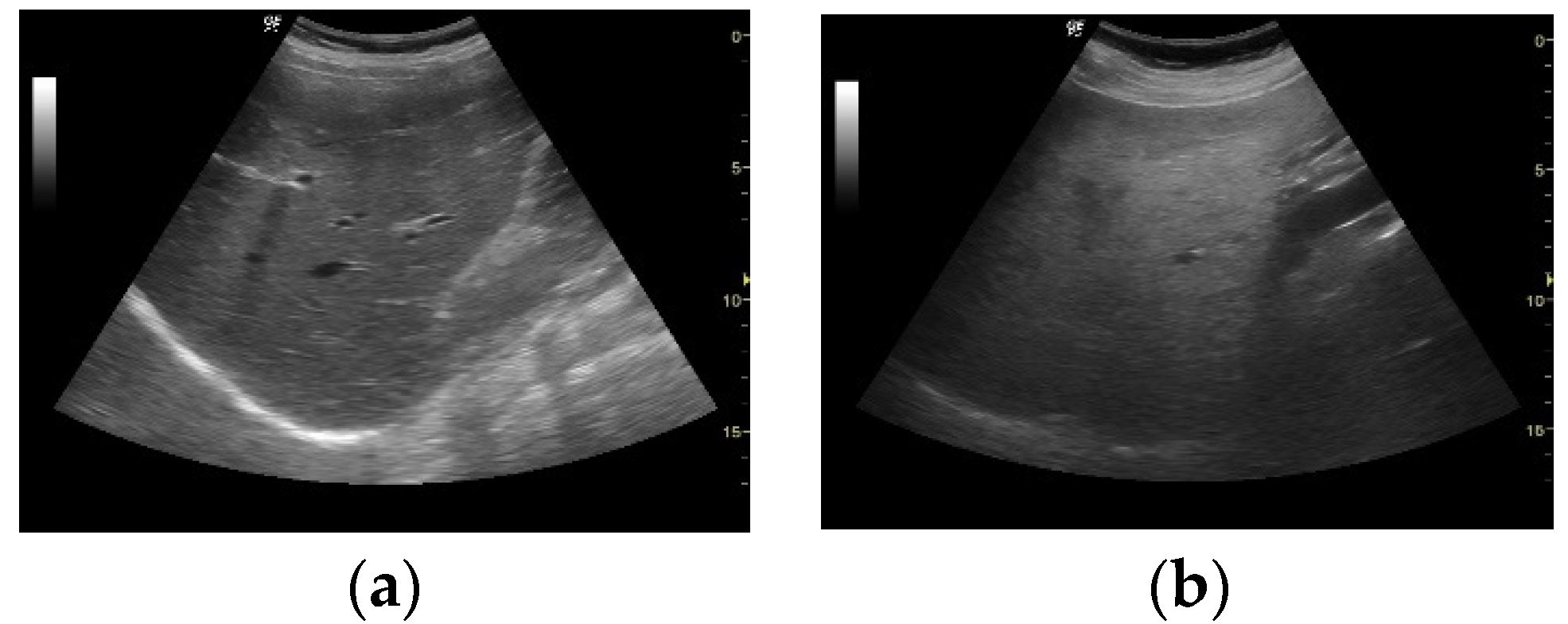 Normal Vs Fatty Liver Ultrasound