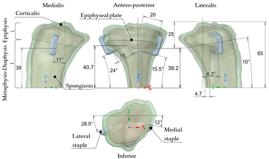 Biomechanical Analysis of Staples for Epiphysiodesis