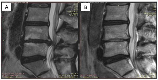 Laser Reconstruction of Spinal Discs Experiments and Clinic