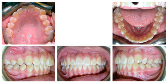 A Simple Technique Using a Modified Nance Appliance as Anchorage for ...
