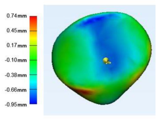 Using Statistical Shape Models to Optimize TKA Implant Design