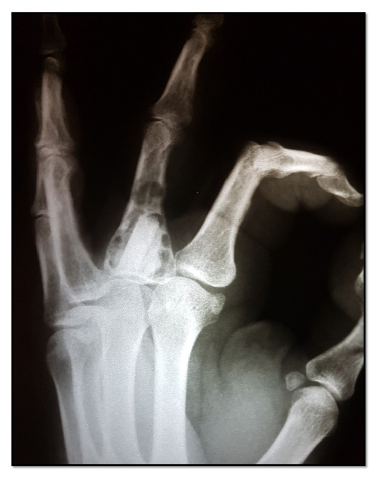 Treatment of Bone Defects Resulted after Excision of Enchondroma of the ...