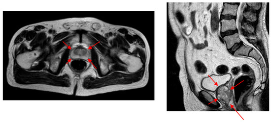 Estimation of the Prostate Volume from Abdominal Ultrasound Images by ...