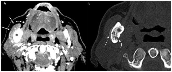 Techniques, Tricks, and Stratagems of Oral Cavity Computed Tomography ...