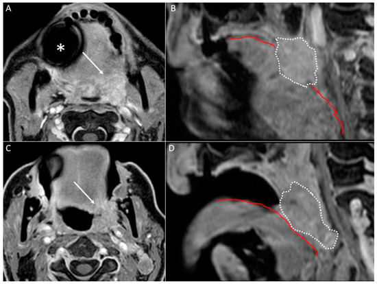 Techniques, Tricks, and Stratagems of Oral Cavity Computed Tomography ...