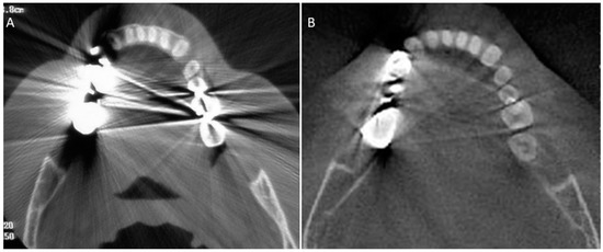 Techniques, Tricks, and Stratagems of Oral Cavity Computed Tomography ...