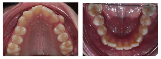 Herbst Appliance Reinforced with an Hybrid Hyrax Expander and Two ...