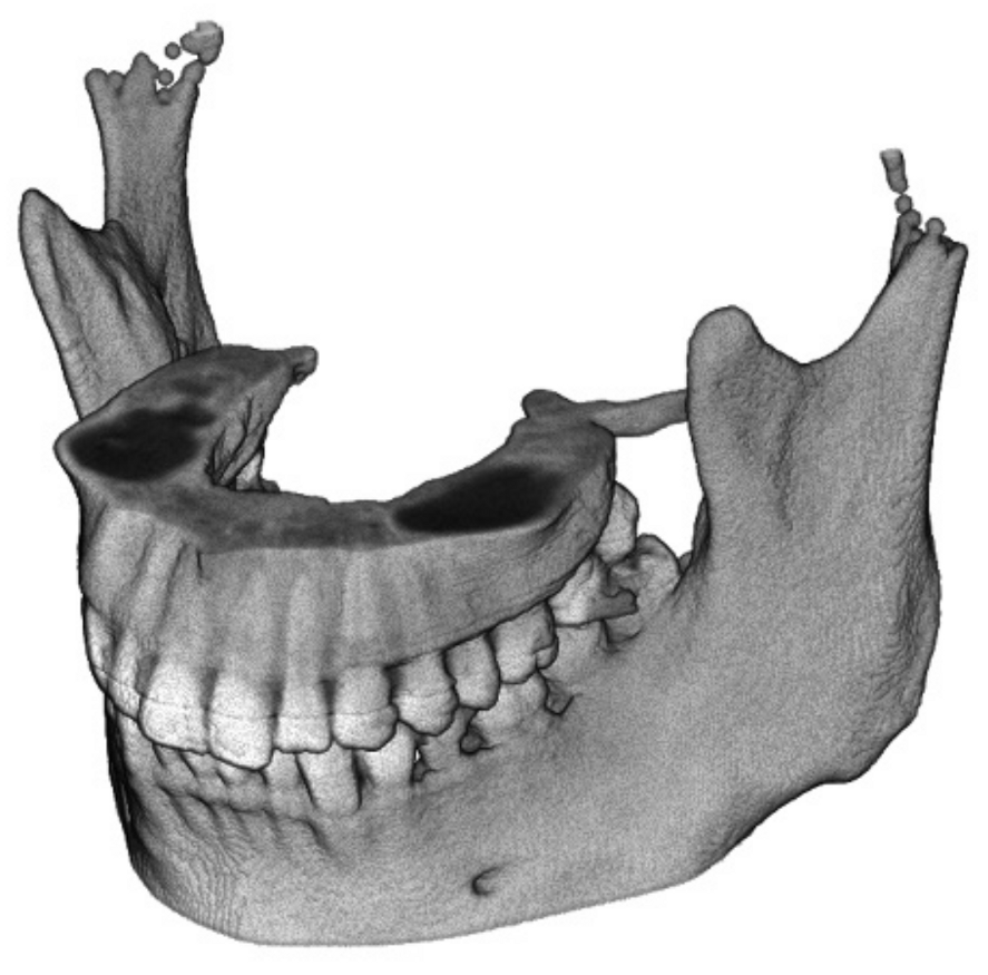 Jawbone Segmentation with Trabecular Bone Preservation from Cone Beam ...
