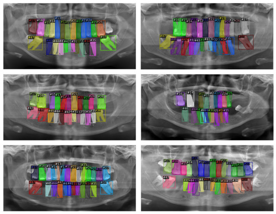 Deep Learning Based Detection of Missing Tooth Regions for Dental ...