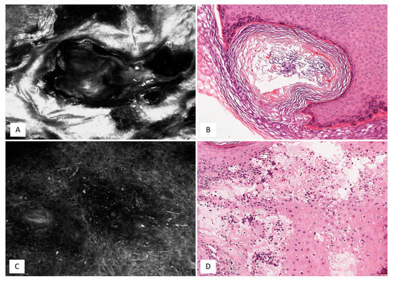 Horizontal Histopathology Correlation with In Vivo Reflectance Confocal ...