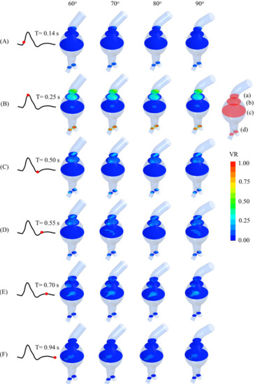 Computational Study of Abdominal Aortic Aneurysms with Severely Angulated Neck Based on ...