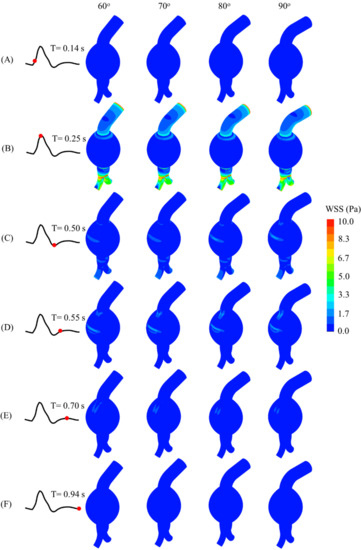 Computational Study of Abdominal Aortic Aneurysms with Severely Angulated Neck Based on ...