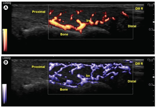 Microvascular Imaging as a Novel Tool for the Assessment of Blood Flow ...