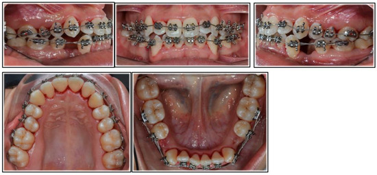 Management of Class III Extraction with the Miniscrew-Supported ...