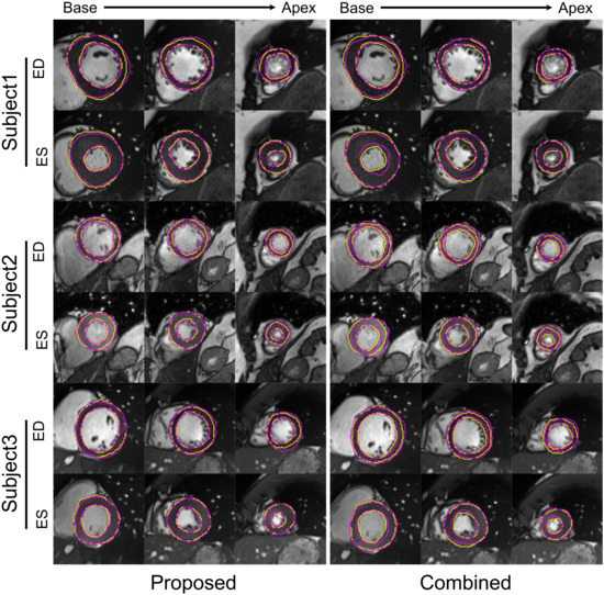 Cardiac Magnetic Resonance Left Ventricle Segmentation and Function ...