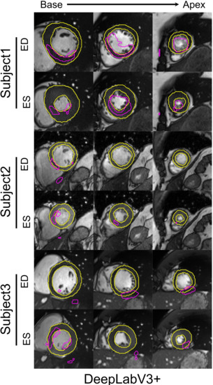 Cardiac Magnetic Resonance Left Ventricle Segmentation and Function ...