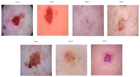 Multiclass Skin Lesion Classification Using a Novel Lightweight Deep Learning Framework for ...
