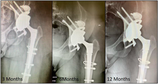 3D Printing Applications in Orthopaedic Surgery: Clinical Experience ...