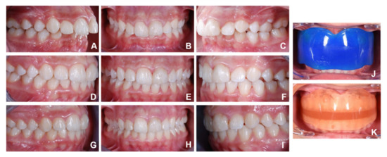 Elastodontic Therapy of Hyperdivergent Class II Patients Using AMCOP ...