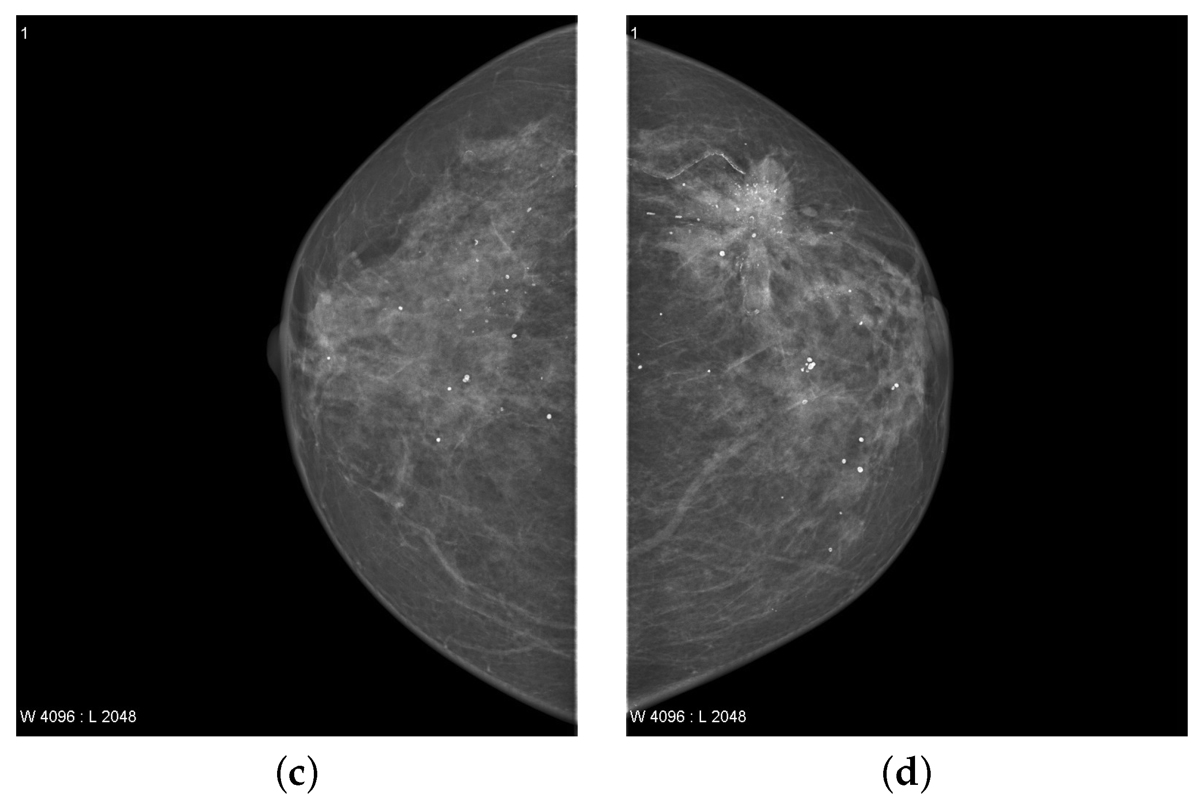 Breast Cancer Mammogram