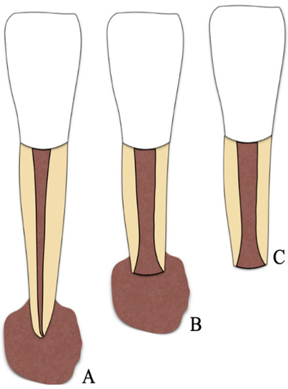 Endodontic Regenerative Procedures in Necrotic Adult Teeth