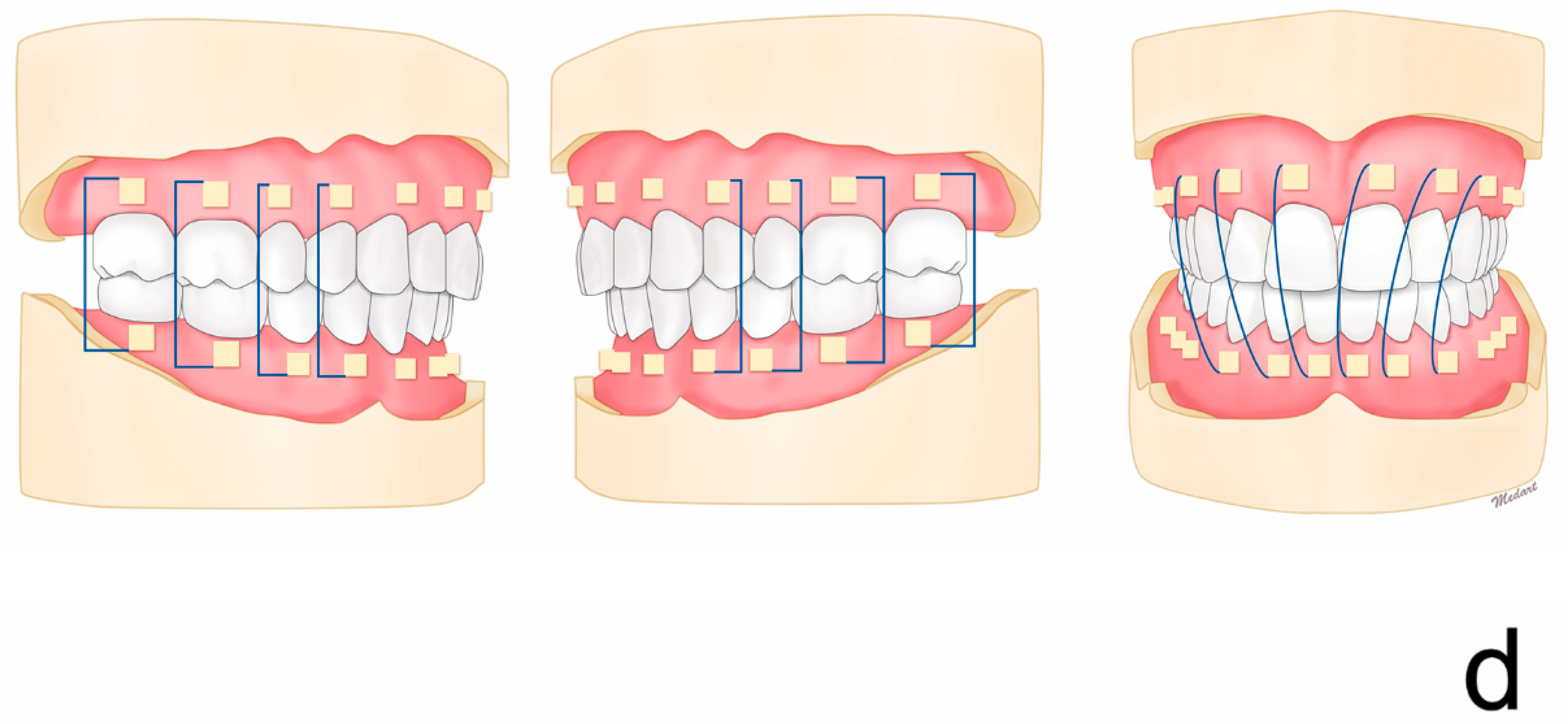 Accuracy of Additively Manufactured Dental Casts Compared with That of ...