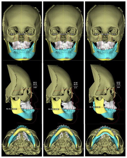 Counterclockwise Rotation Jaw