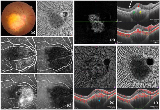 Clinical Observation of Choroidal Osteoma Using Swept-Source Optical ...