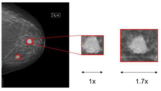 Two-Stage Deep Learning Method for Breast Cancer Detection Using High ...