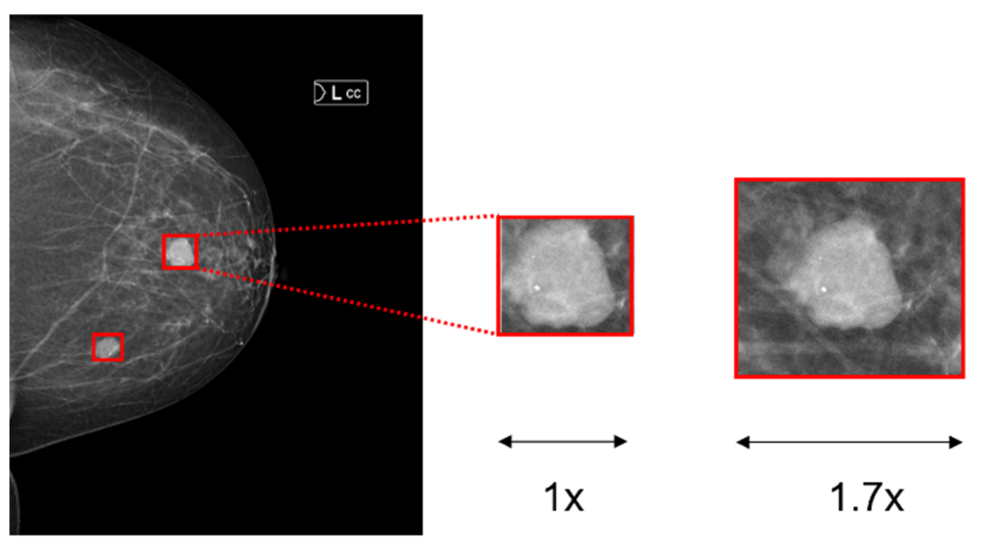 Applied Sciences Free Full Text Two Stage Deep Learning Method For Breast Cancer Detection
