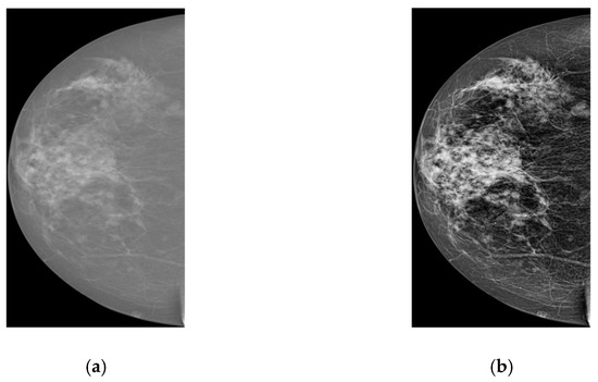 Two-Stage Deep Learning Method for Breast Cancer Detection Using High ...
