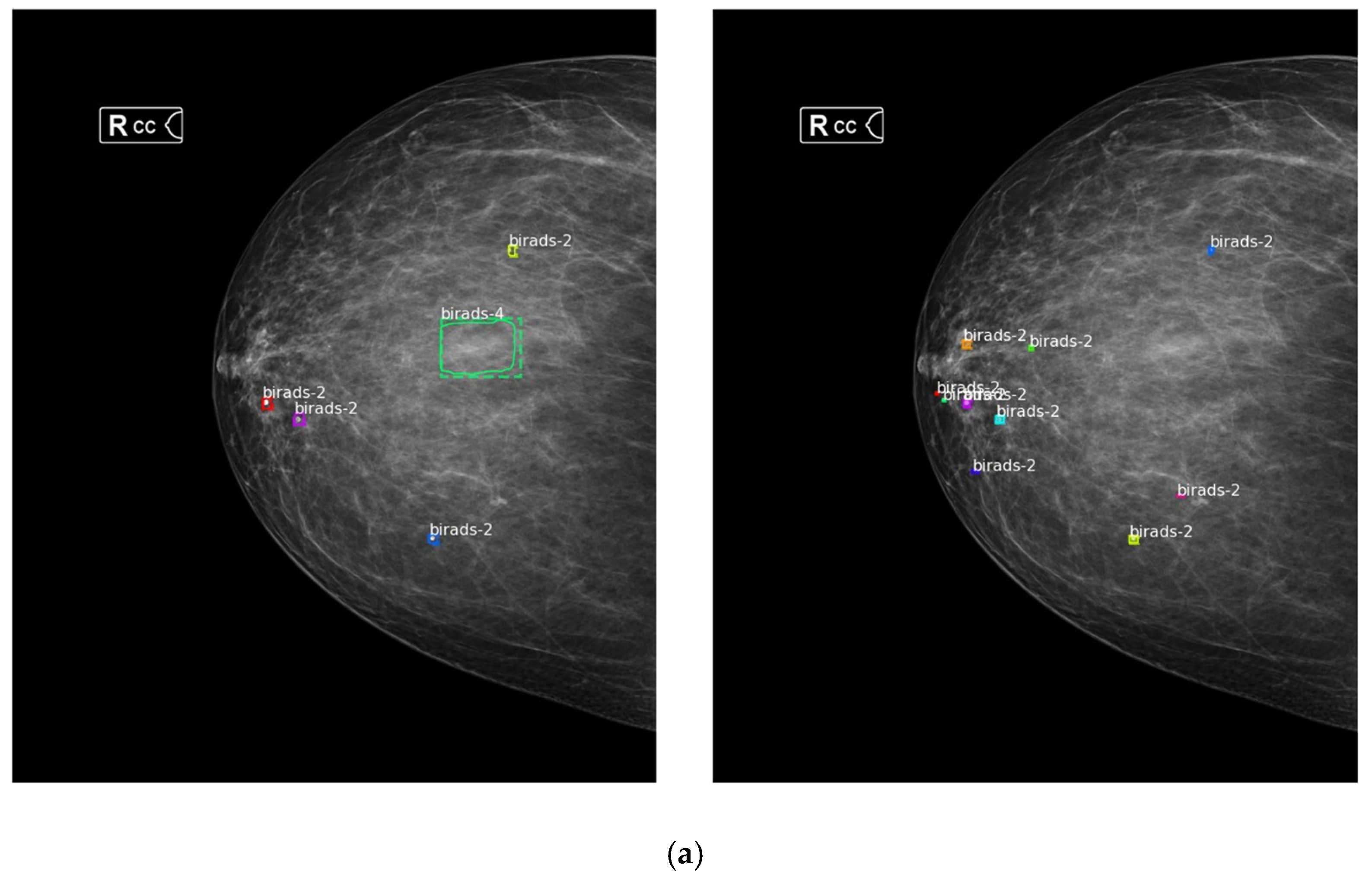 Two-Stage Deep Learning Method for Breast Cancer Detection Using High-Resolution Mammogram Images